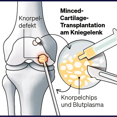 Sie haben Kniearthrose? Das sind die besten Behandlungsmethoden