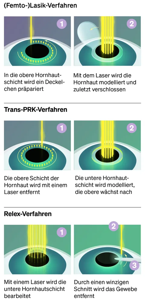 Augen Lasern Risiko